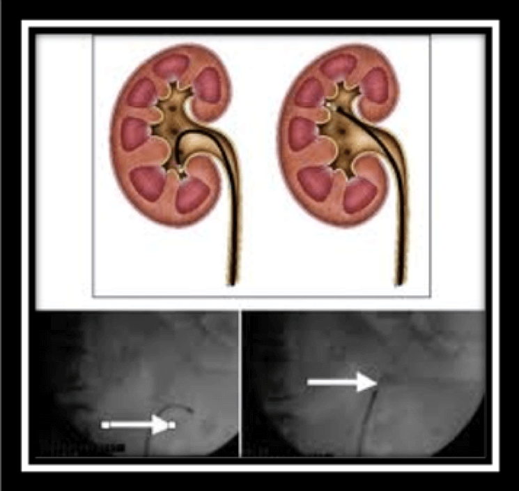 Lithiase urinaire | Urologues Saint Augustin